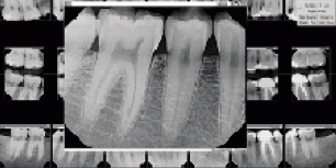 Low Radiation Digital X-Rays | Dexis | Dental Care